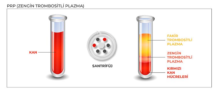 PRP Nedir? PRP Tedavisi, Uygulamaları ve Fiyatları | VBB Gentek